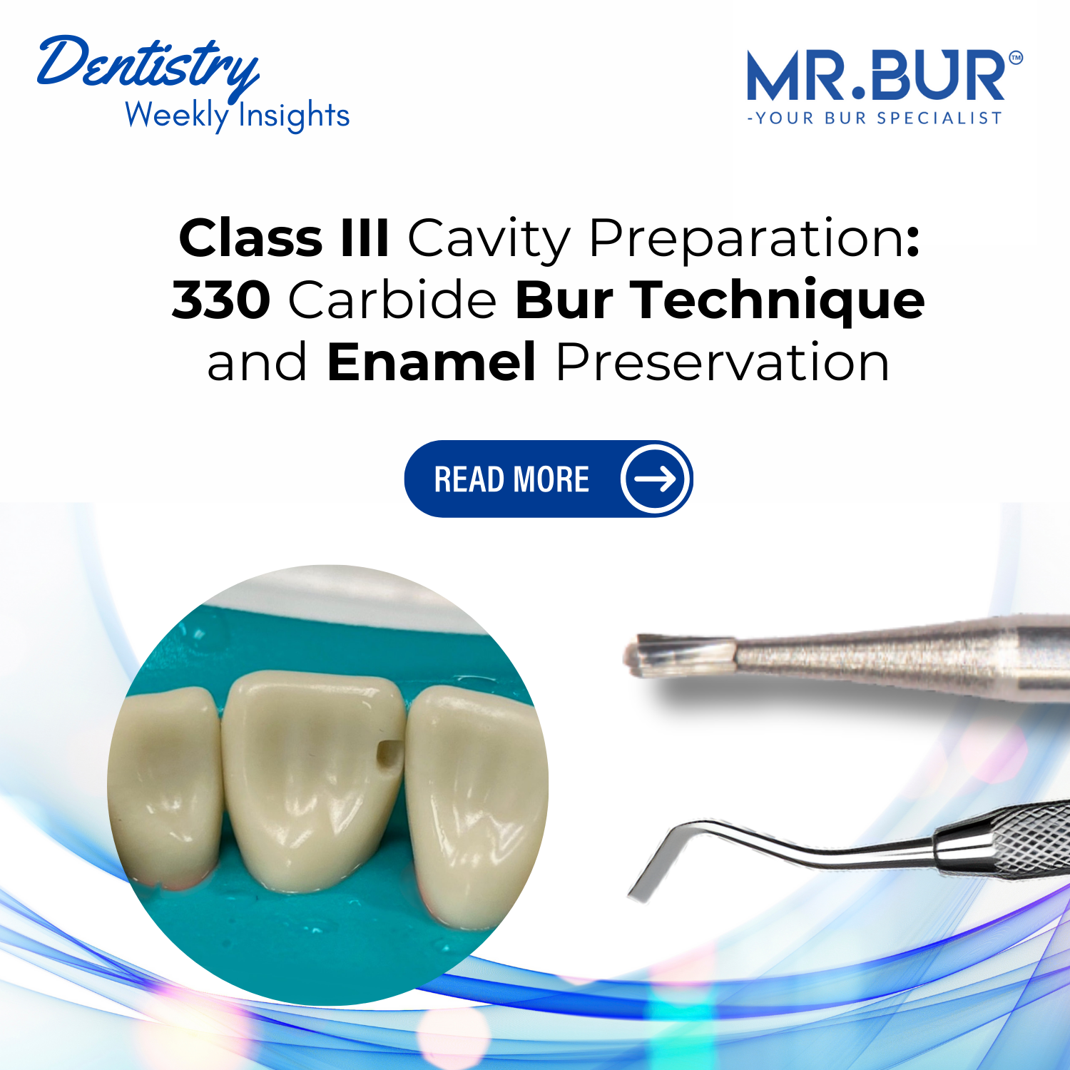 Class III Cavity Preparation: 330 Carbide Bur Technique and Enamel Pre ...