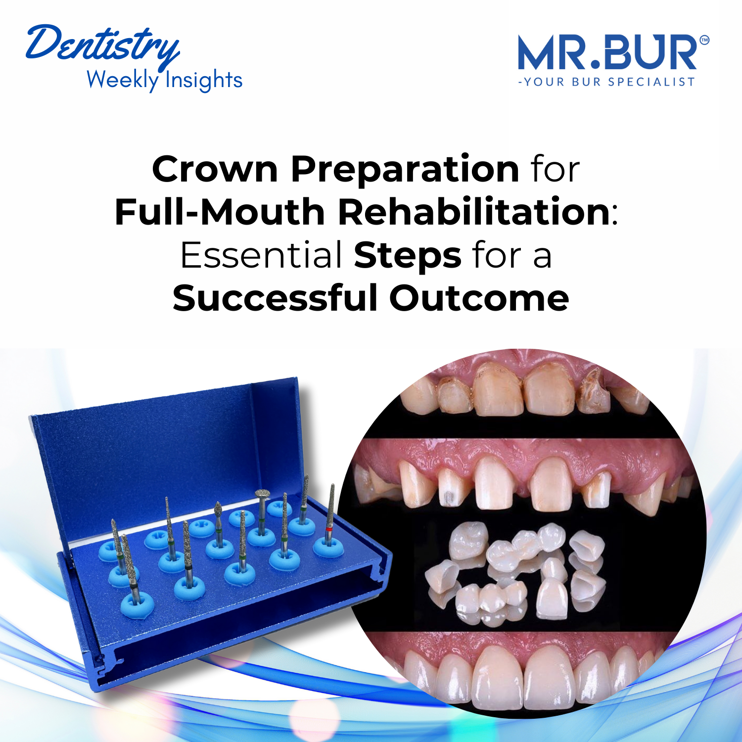Crown Preparation for Full-Mouth Rehabilitation: Essential Steps for a ...