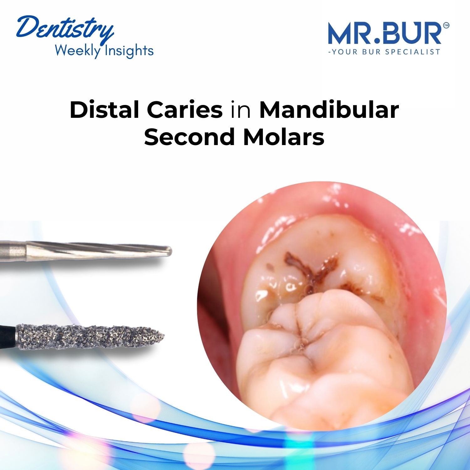 Distal Caries in Mandibular Second Molars – Mr Bur