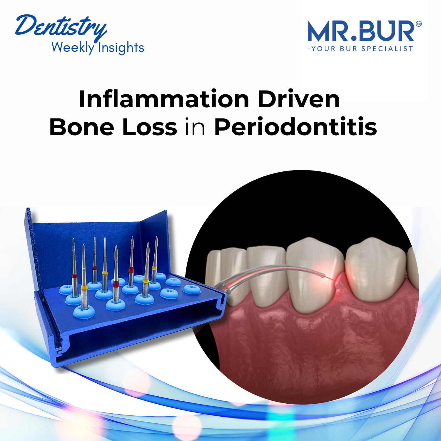 Inflammation-Driven Bone Loss in Periodontitis – Mr Bur