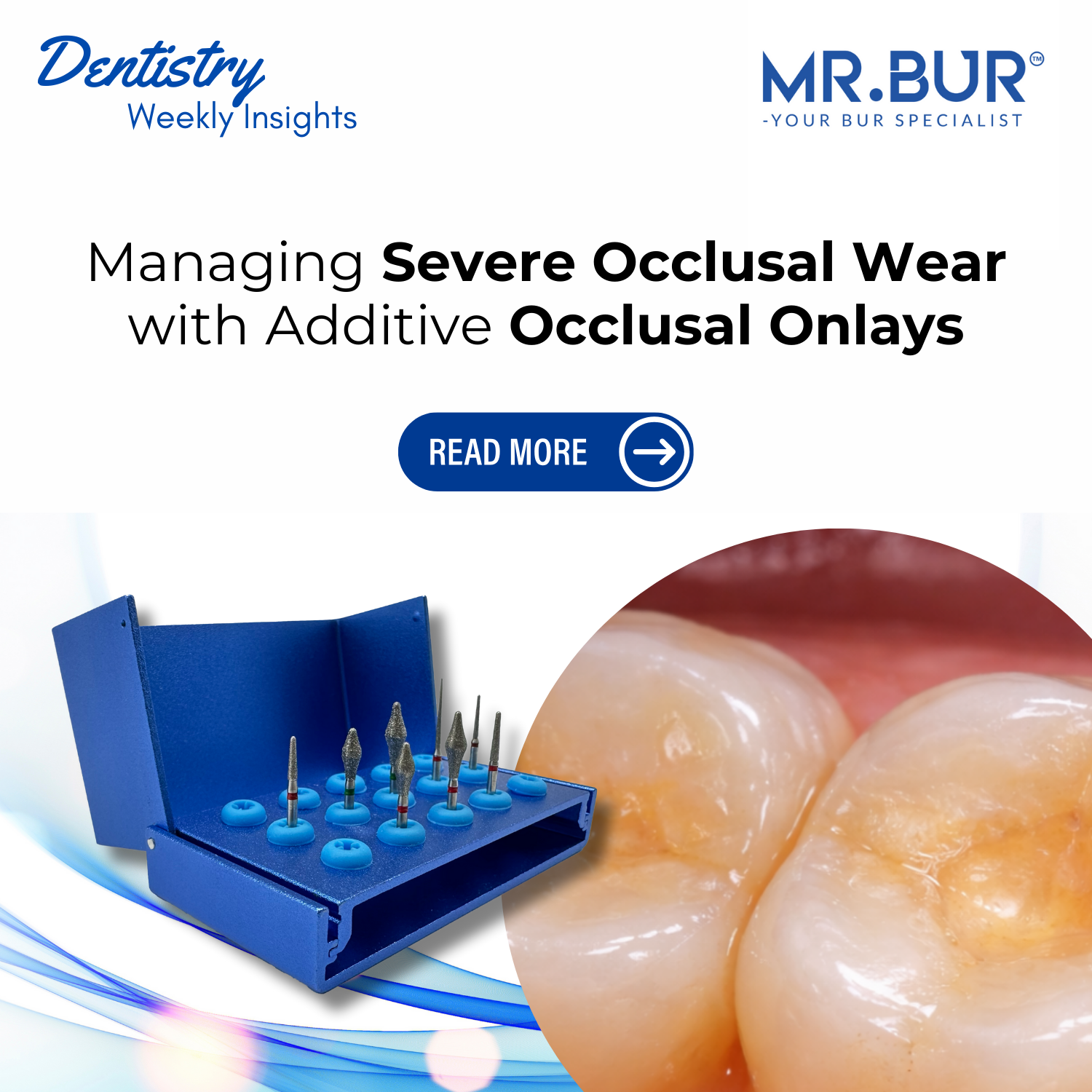 Managing Severe Occlusal Wear with Additive Occlusal Onlays – Mr Bur
